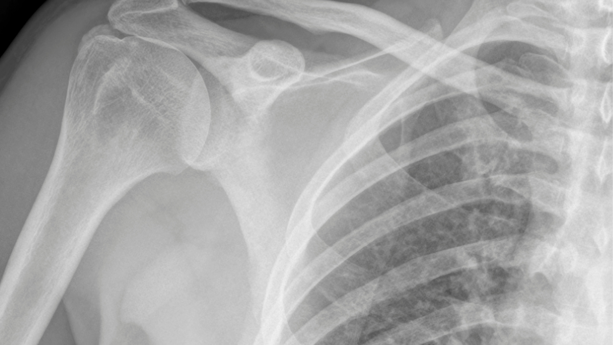Heal a Rotator Cuff without Surgery? - Emily Frye Homeopathy
